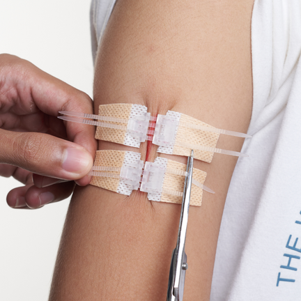 ZipClose – Needle and Stitch Free Wound Closure