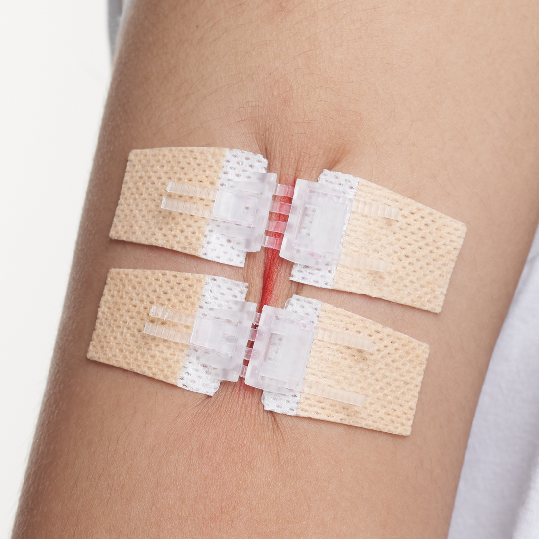 ZipClose – Sutureless Wound Closure Solutions