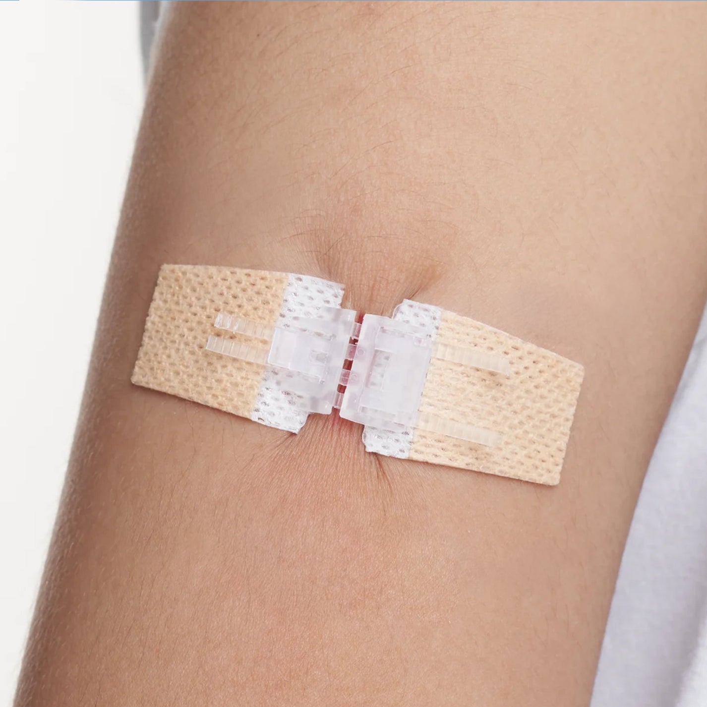 ZipClose – Sutureless Wound Closure Solutions