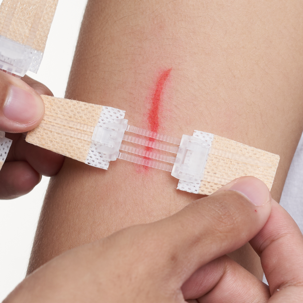 ZipClose – Needle and Stitch Free Wound Closure