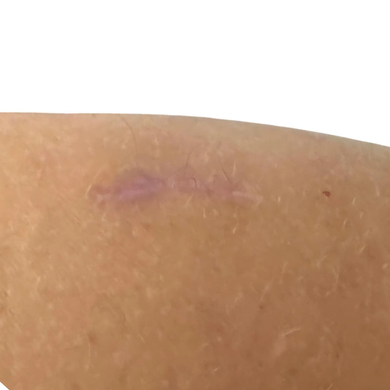 ZipClose – Sutureless Wound Closure Solutions